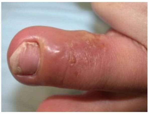 WHITLOW: SPOT THE EARLY SYMPTOMS AND PREVENT IT Whitlow is a painful ...