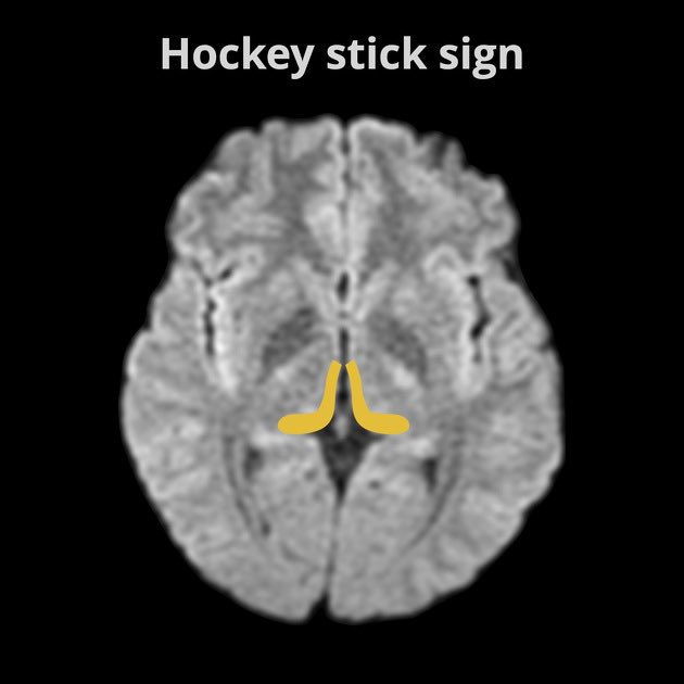👩🏽‍💻𝘀𝗶𝗴𝗻𝗼𝘀 𝘤𝘭𝘢́𝘴𝘪𝘤𝘰𝘴 de 𝗻𝗲𝘂𝗿𝗼𝗶𝗺𝗮𝗴𝗲𝗻🩻 que ayudan en el diagnóstico⚖ ...