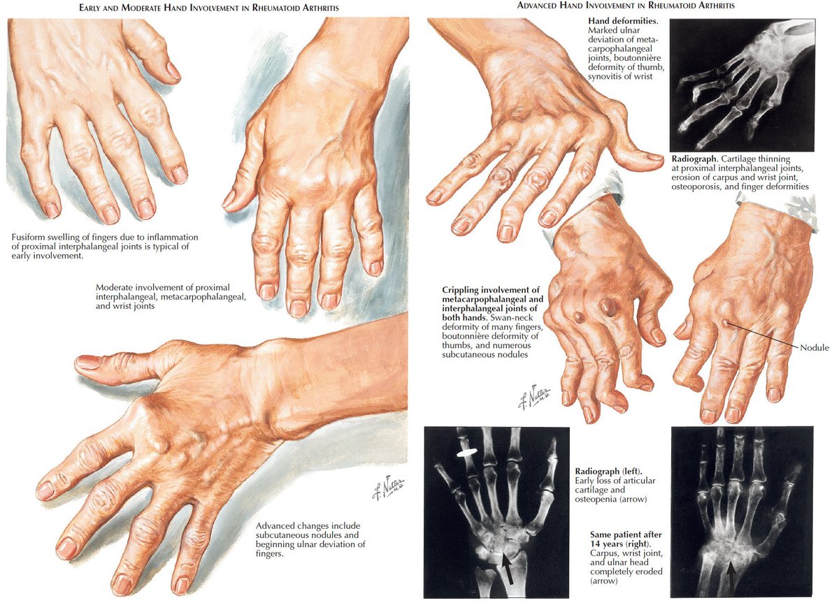 Rheumatoid Arthritis Nodules On Fingers