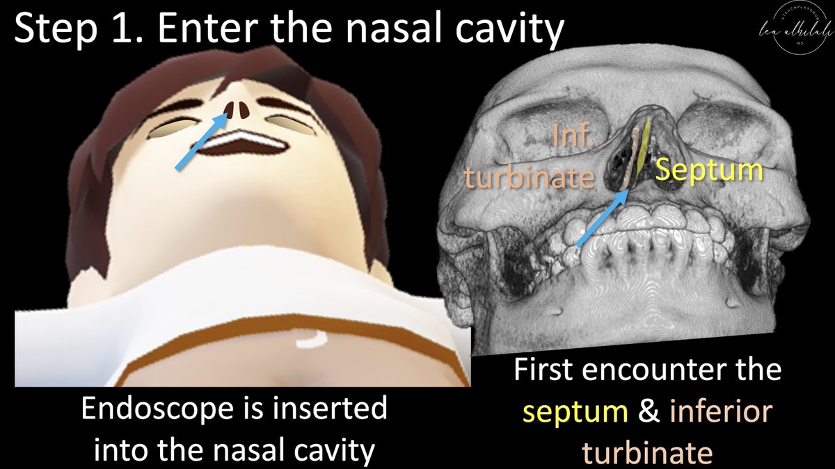 1/Time to FESS up! Do you understand functional endoscopic sinus ...