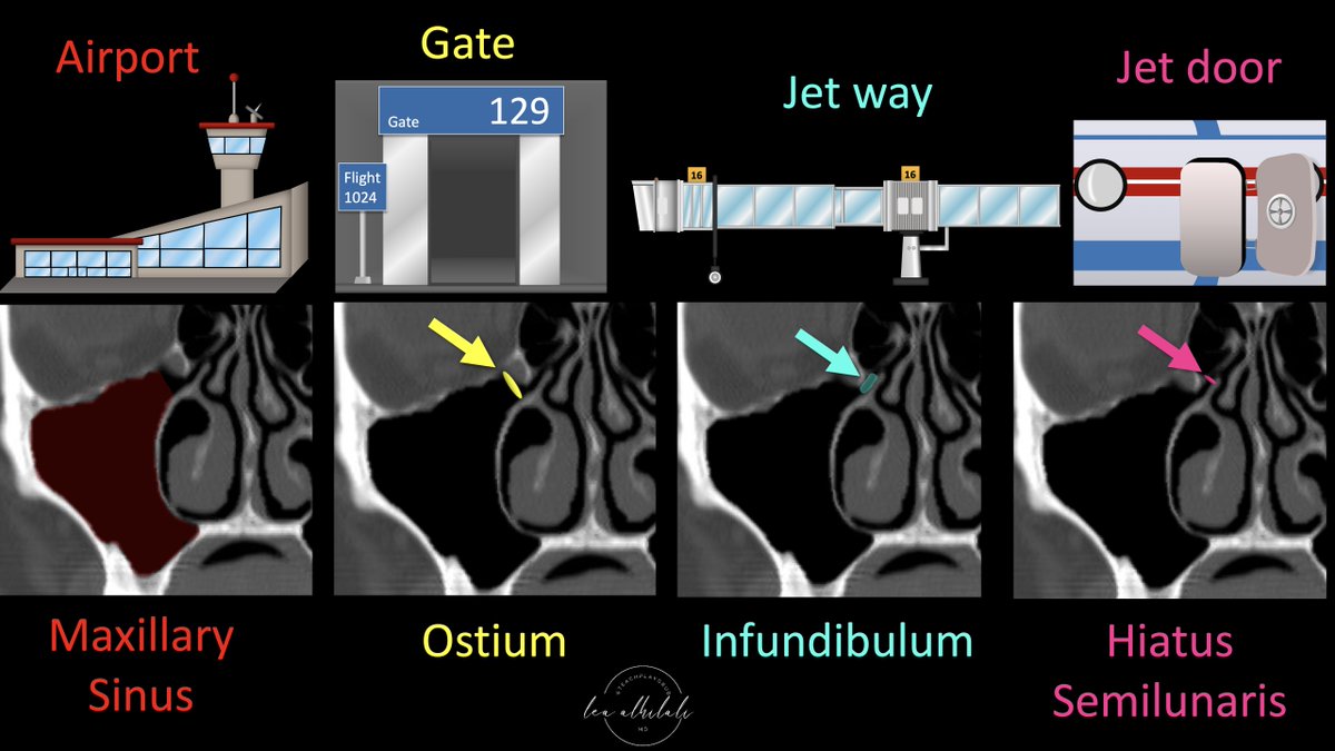 1/Time to FESS up! Do you understand functional endoscopic sinus ...