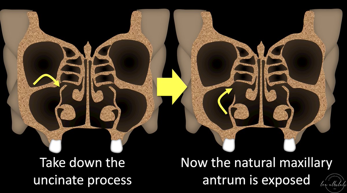 1/Time to FESS up! Do you understand functional endoscopic sinus ...