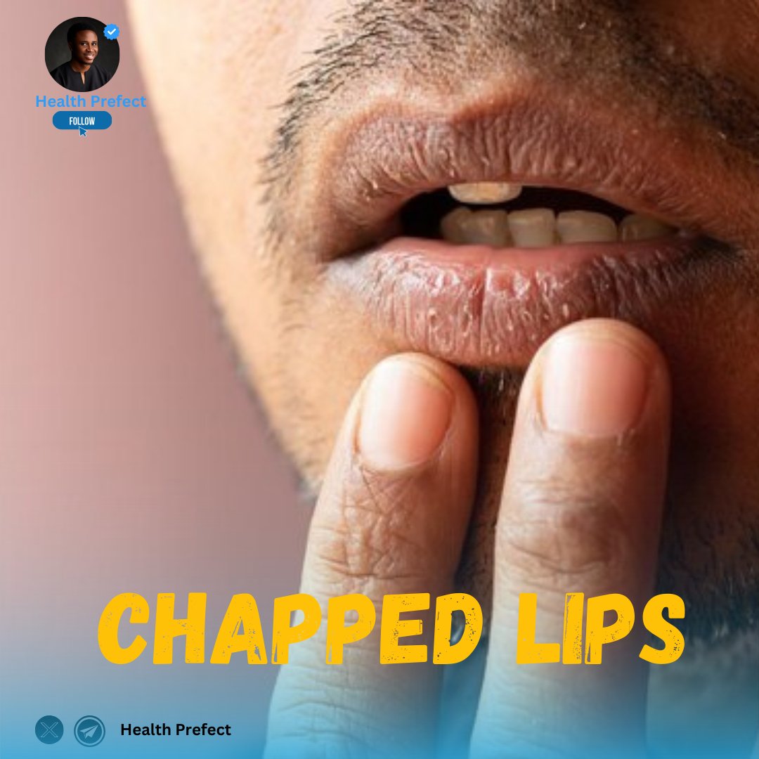 Say Goodbye to Chapped Lips: Causes, Treatments, and Prevention 💋 ️ ...