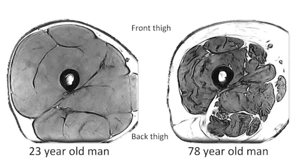By 70, you could lose half your muscle mass. The result? Frailty ...