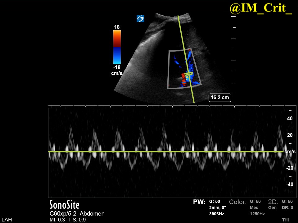 ICU Stories (fresh out of oven): Young patient with hx of polysubstance ...