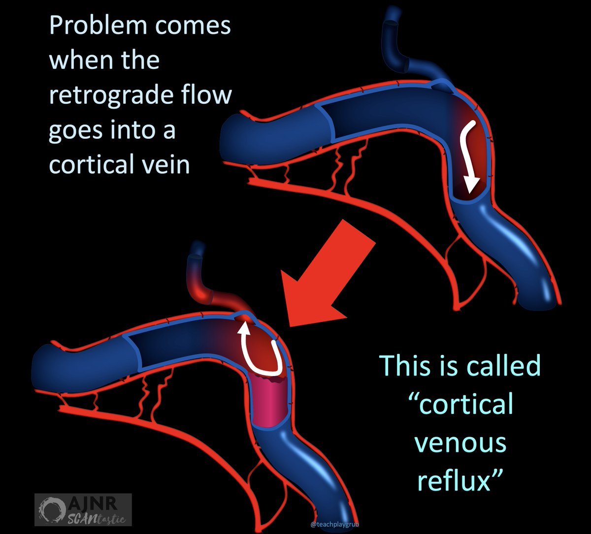 1/Talk about dangerous liaisons! Abnormal brain vascular connections ...