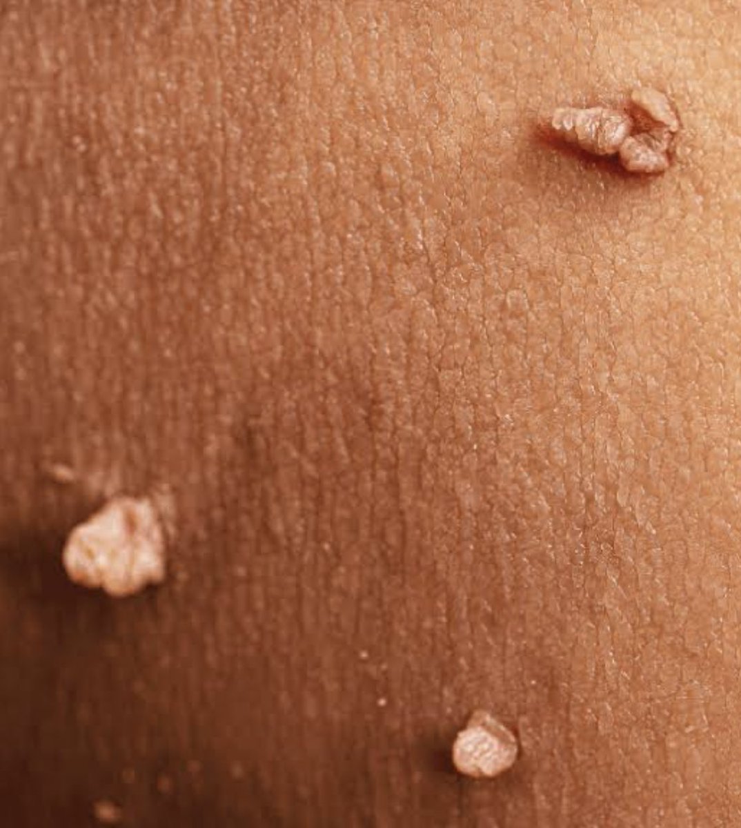 WHAT’S THAT GROWTH? Have you ever wondered what skin tags are, and why ...