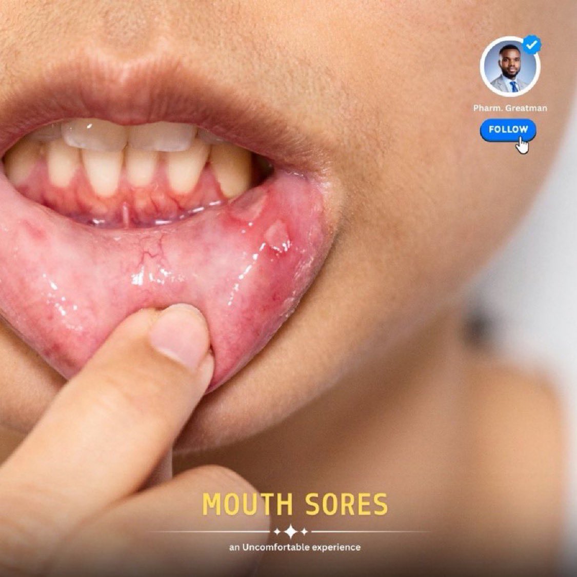 MOUTH SORES Have you ever had a painful sore pop up in your mouth ...