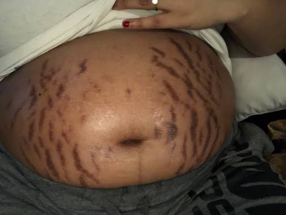 STRETCH MARKS Stretch marks are indented streaks that appear on the ...