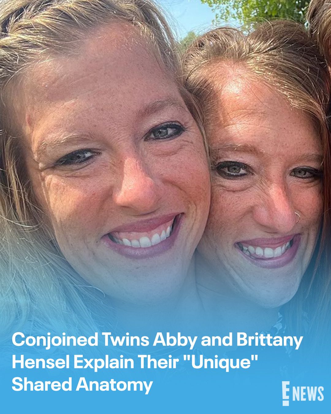 Abigail En Brittany Hensel Anatomie