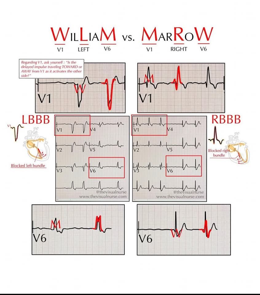 Rbbb Vs Lbbb A Systematic Review