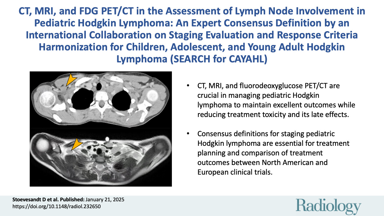 Hodgkins Lymphoma Radiology