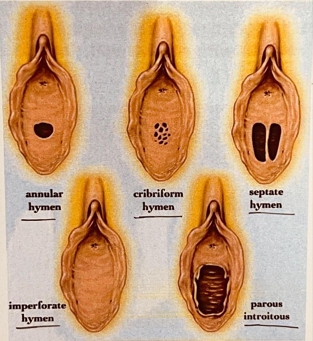 Images Of A Broken Hymen