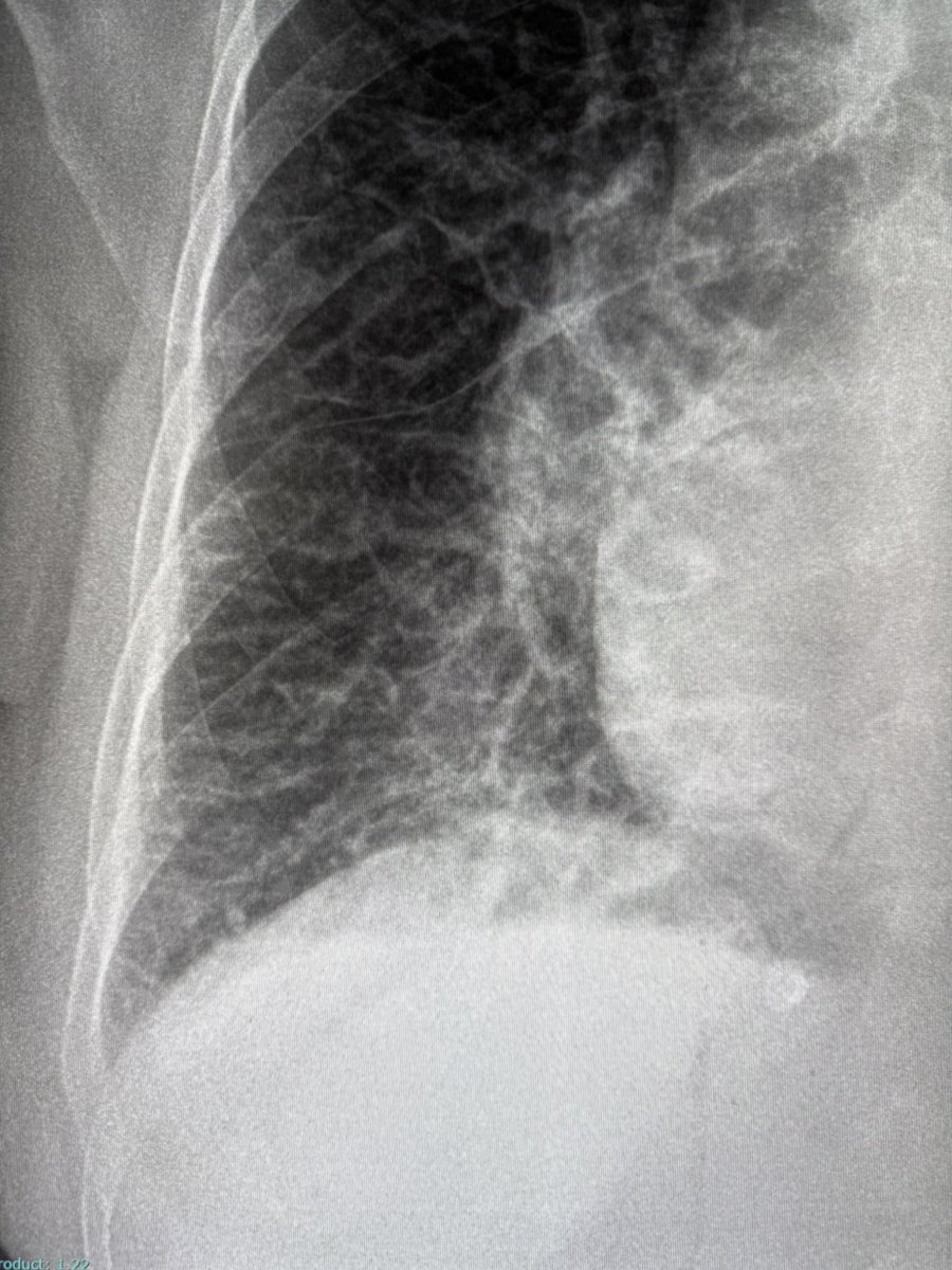 Kerley B Lines Radiopaedia