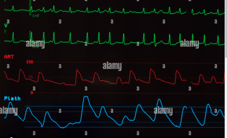 Rapid atrial fibrillation is common in the ICU. How do you decide ...