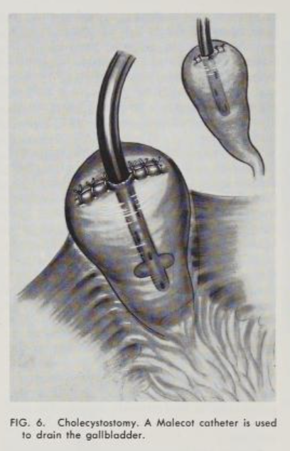 Pezzer Catheter