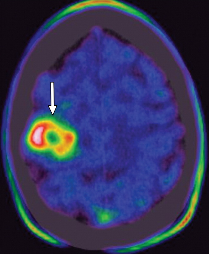 🩻🧠☠️🧵 MRI Modalities & Their Key Uses in Neurosurgery 1/ MRI is ...