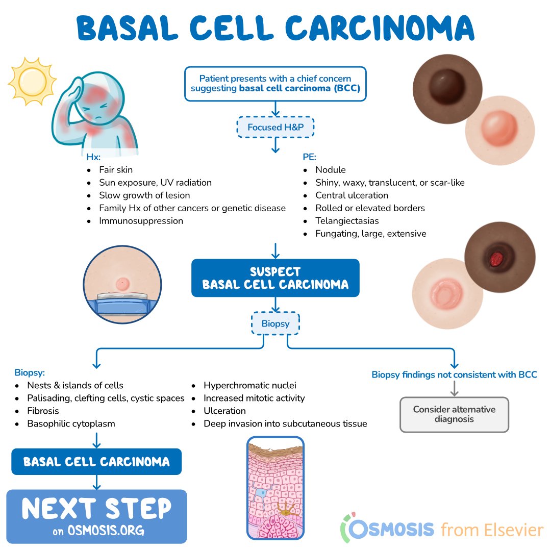 Basal cell carcinoma, or BCC for short, is the most common type of skin ...