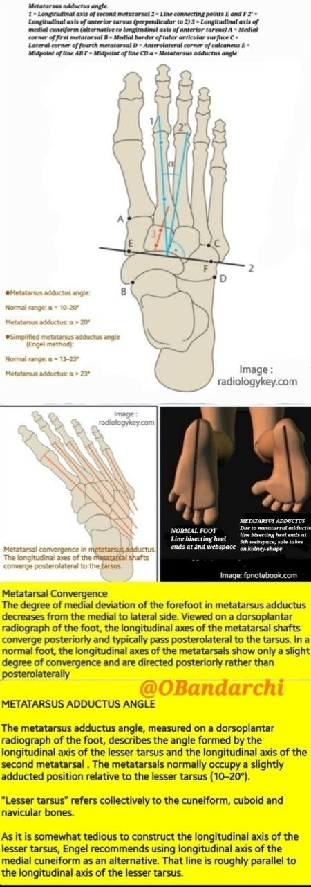 Metatarsus Adductus Angle
