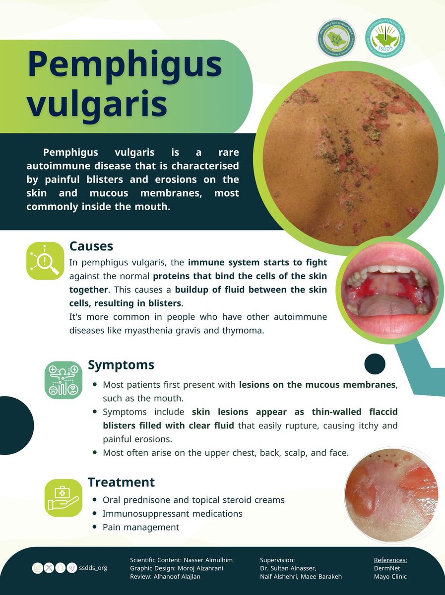 Pemphigus vulgaris is an autoimmune disorder characterized by the ...