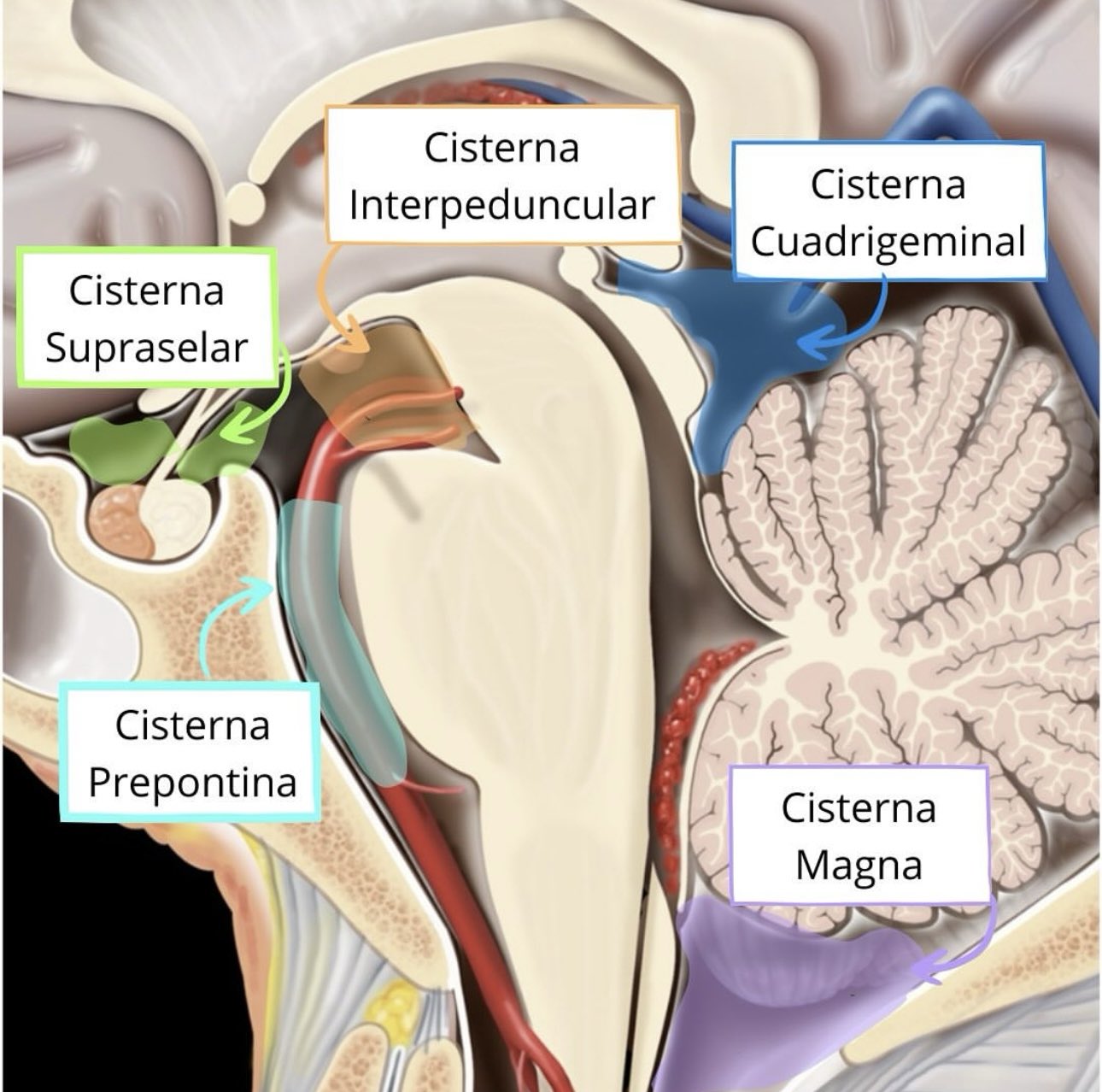 Anatomía De La Cisterna Supraselar Figure 1 From Lesiones Con