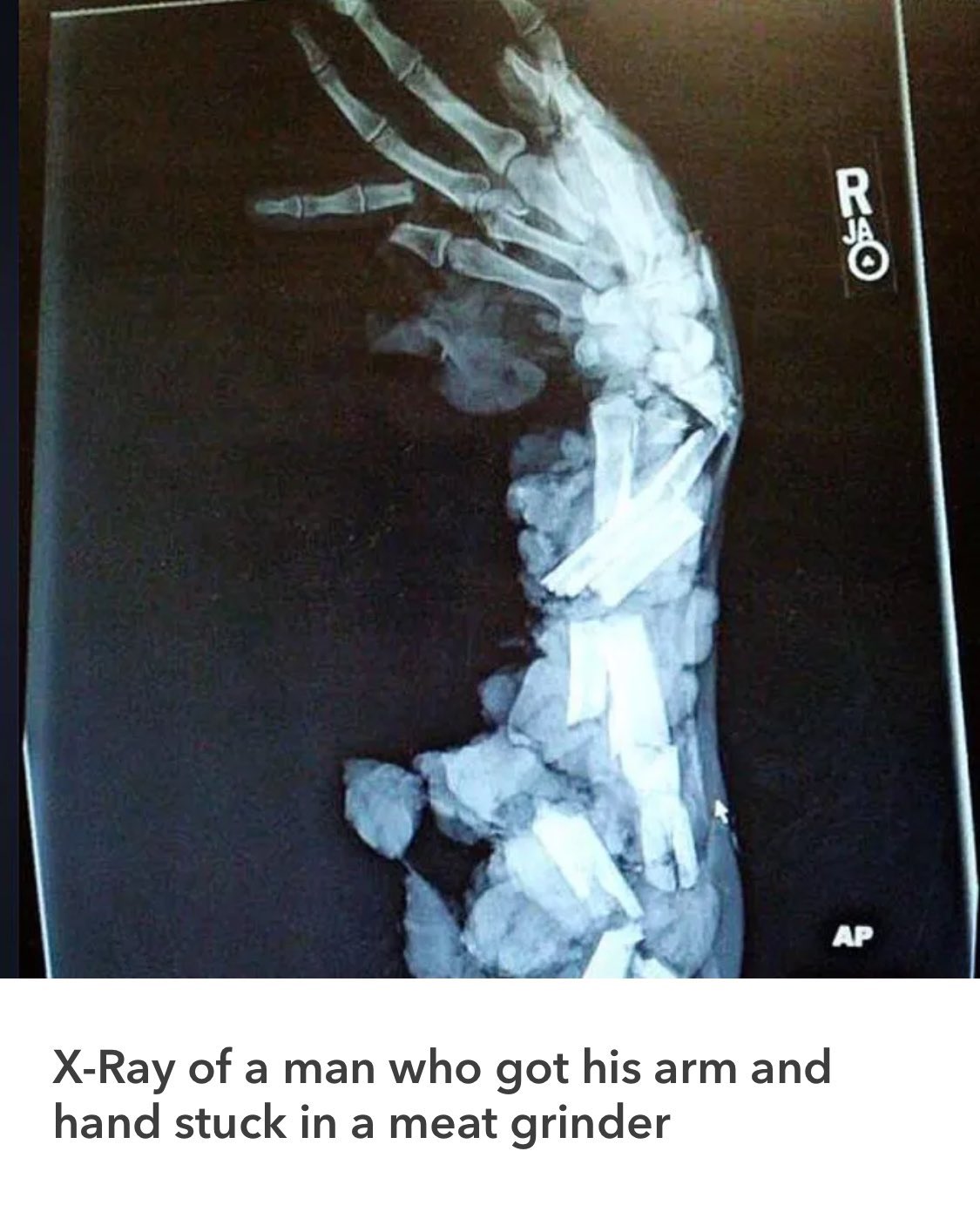 Hand Stuck In Meat Grinder
