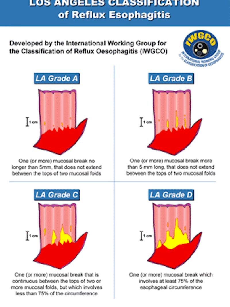 Reflux Esophagitis Esophageal Dysmotility Occurs When The Esophagus