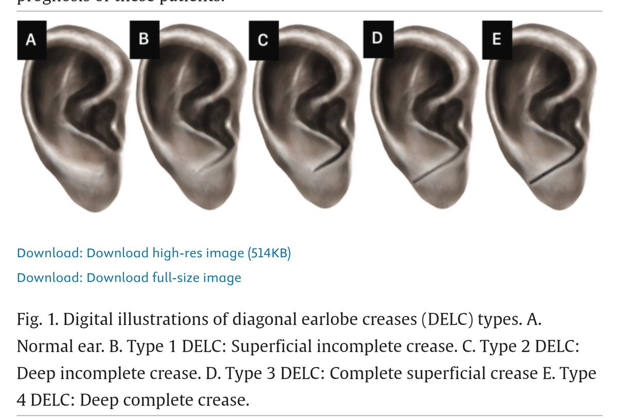 Frank's sign, also known as the diagonal earlobe crease (DELC), is a ...