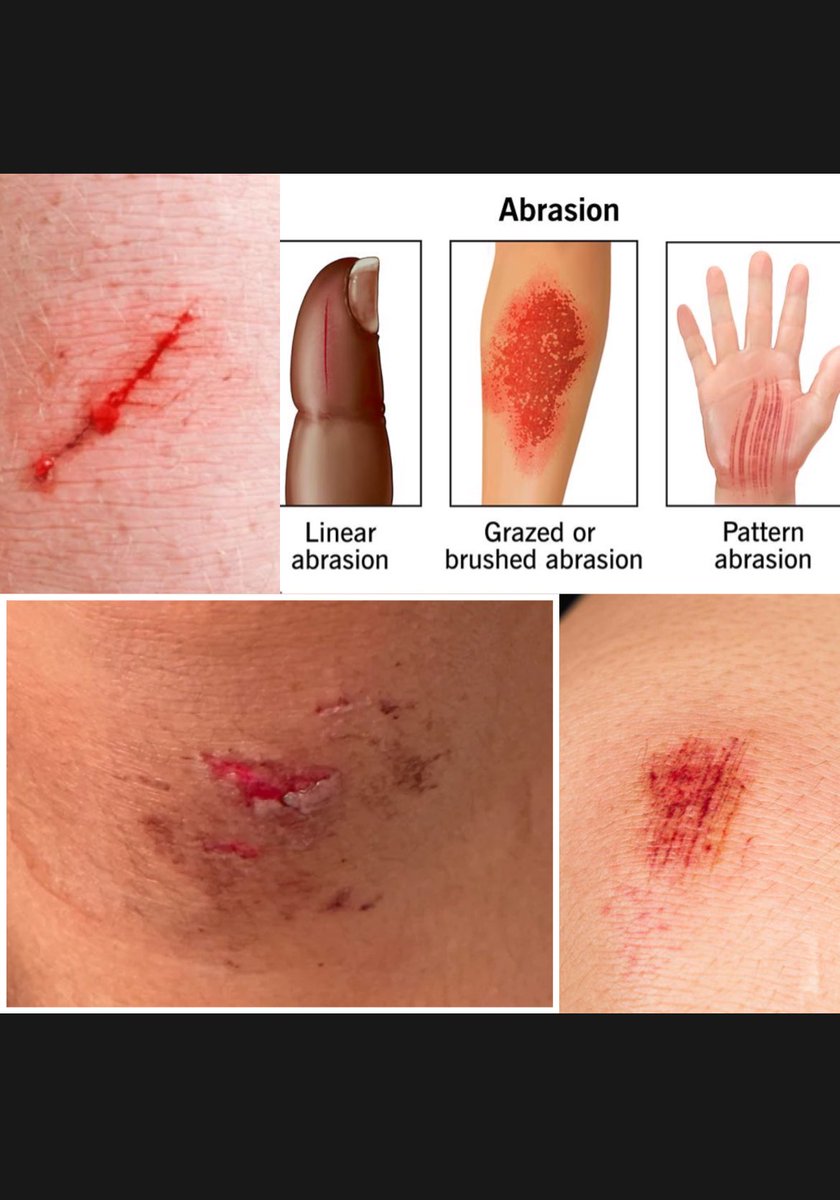 Skin Abrasions
