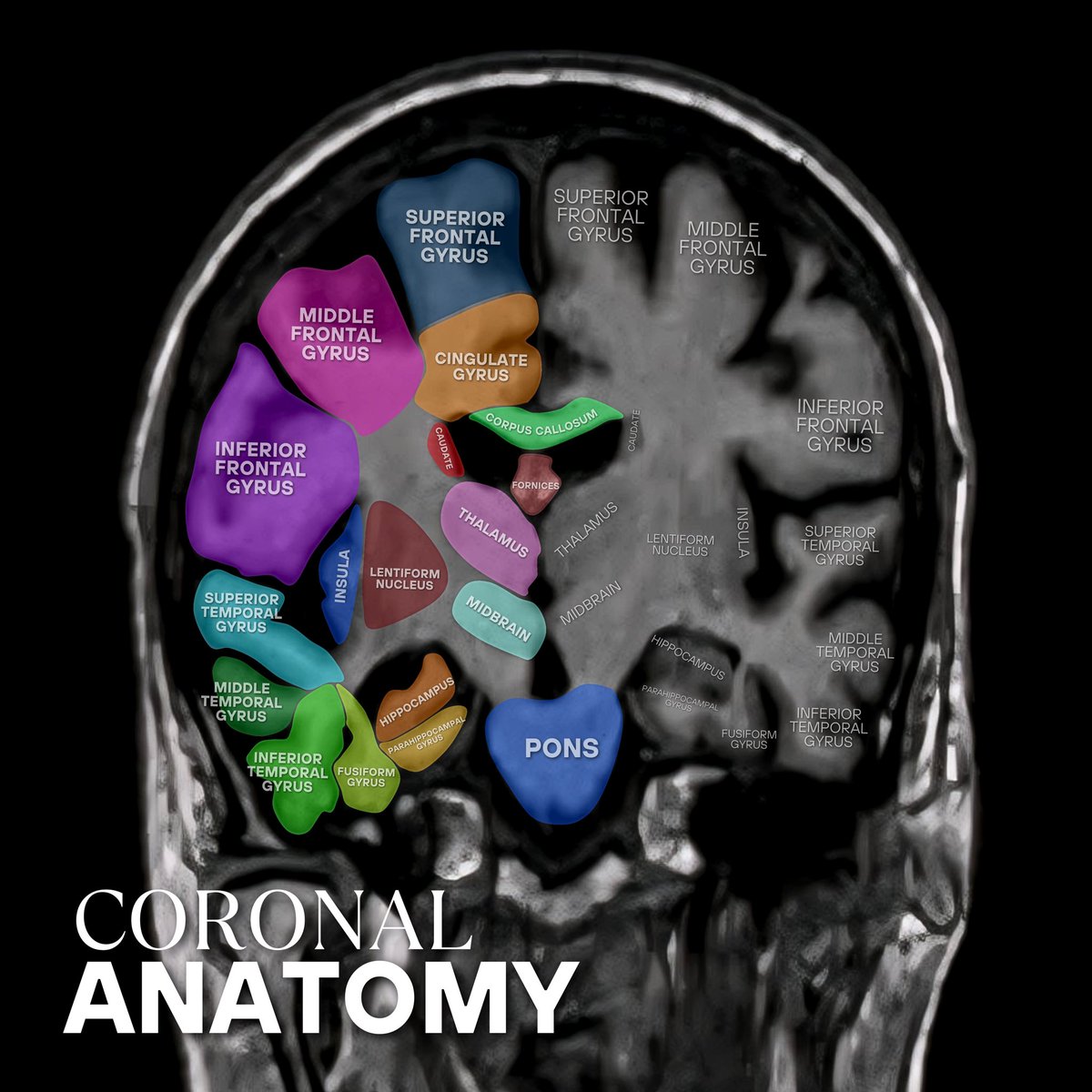 Fusiform Gyrus Coronal