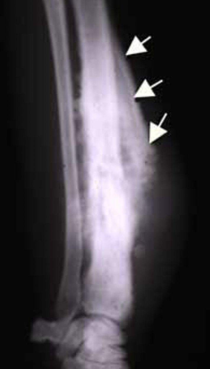 Ewing Sarcoma X Ray Onion Skin Sonographic Appearance Of Ewing's