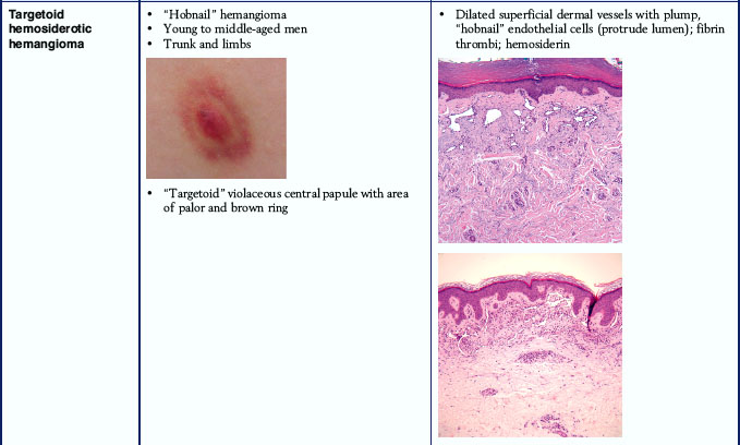 Targetoid hemosiderotic hemangioma (hobnail hemangioma) 🔹Solitary red ...