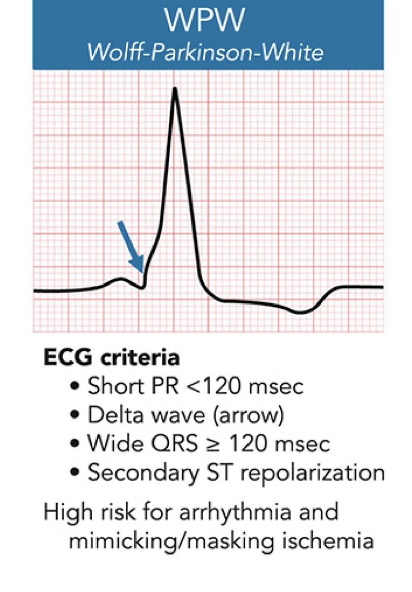 Ecg Delta Waves