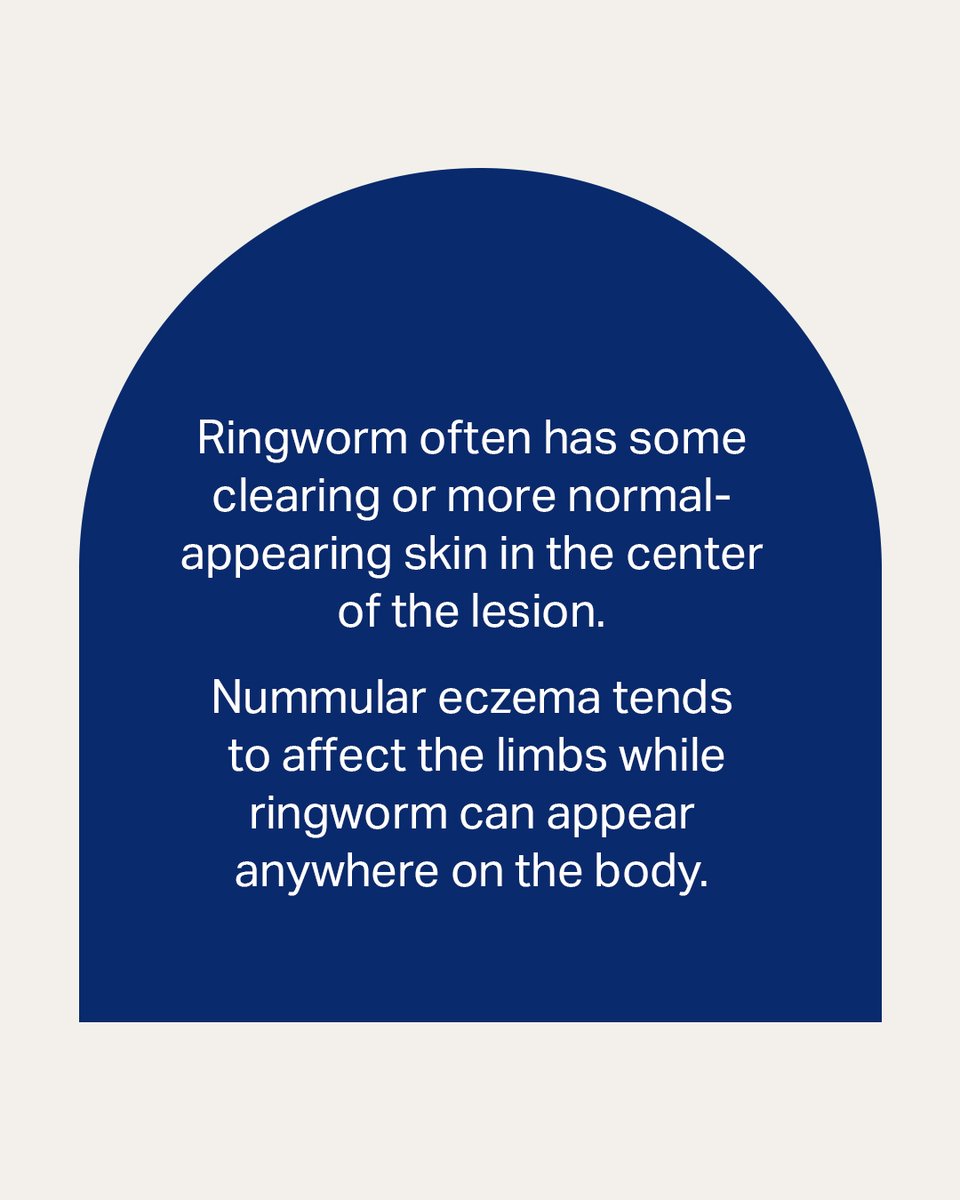 Difference Between Nummular Eczema And Ringworm