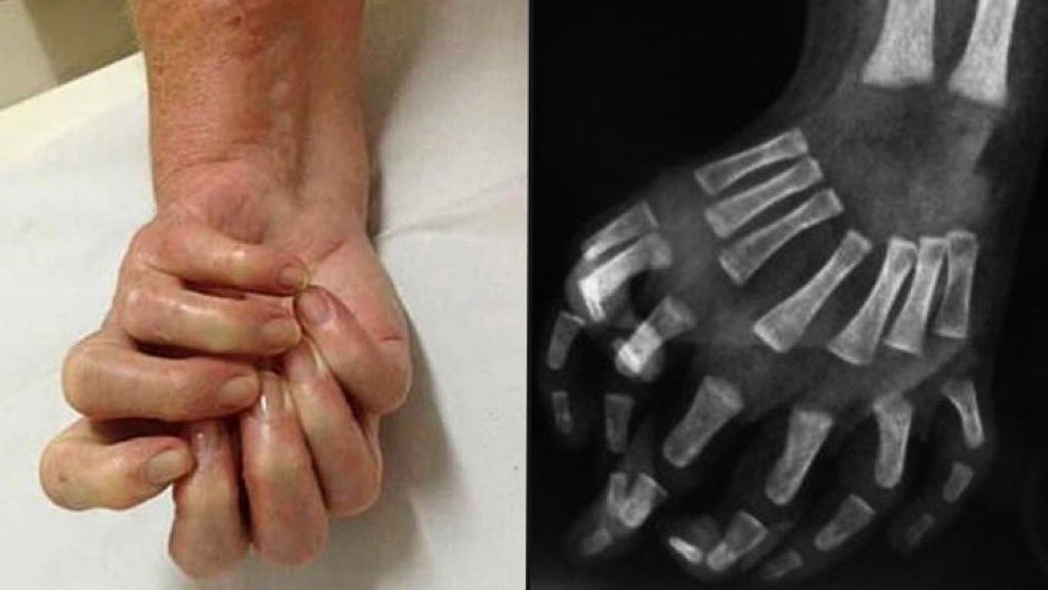 Mirror hand syndrome is an exceptionally rare congenital birth defect ...