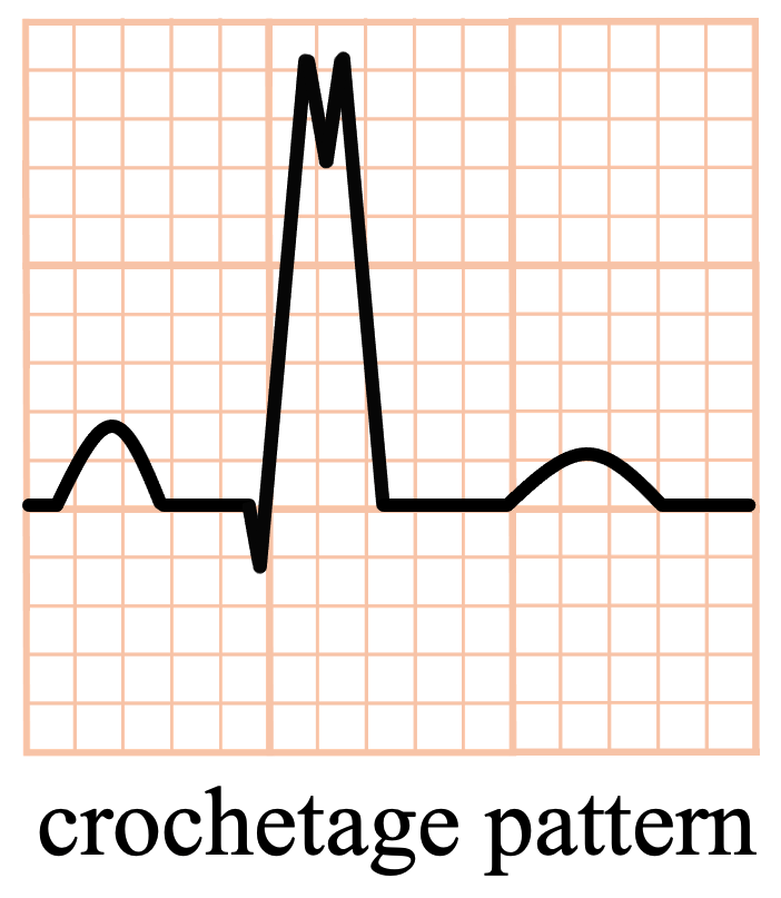 Crochetage sign in ECG is seen which condition? A- VSD B- ASD C- PDA D-TOF