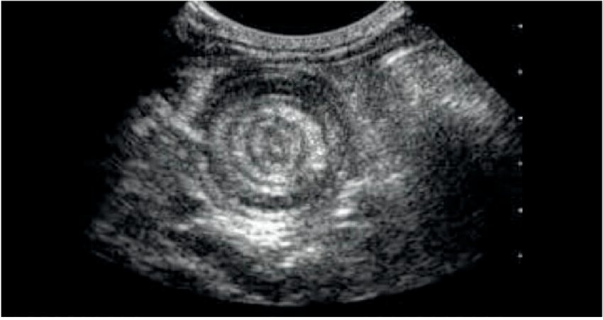 USG abdomen represents: A) Free fluid with bowel loops B) Concentric ...