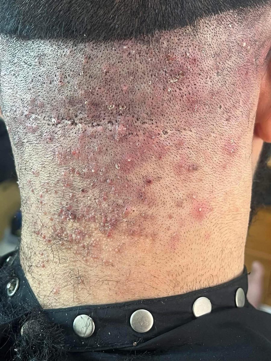 A 24-year-old male presents with multiple pustules and painful, firm ...