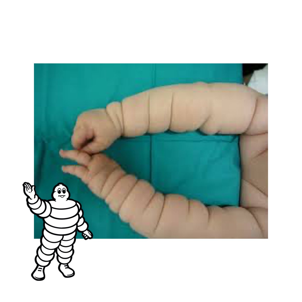 ・ミシュランタイヤベビー症候群（Michelin tire baby syndrome） 脚や首などに輪状のしわが見られる先天性の疾患。名前の ...