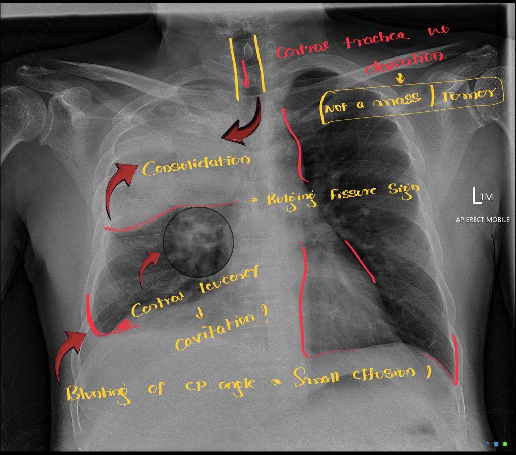 Bulging Fissure Sign Radiopaedia