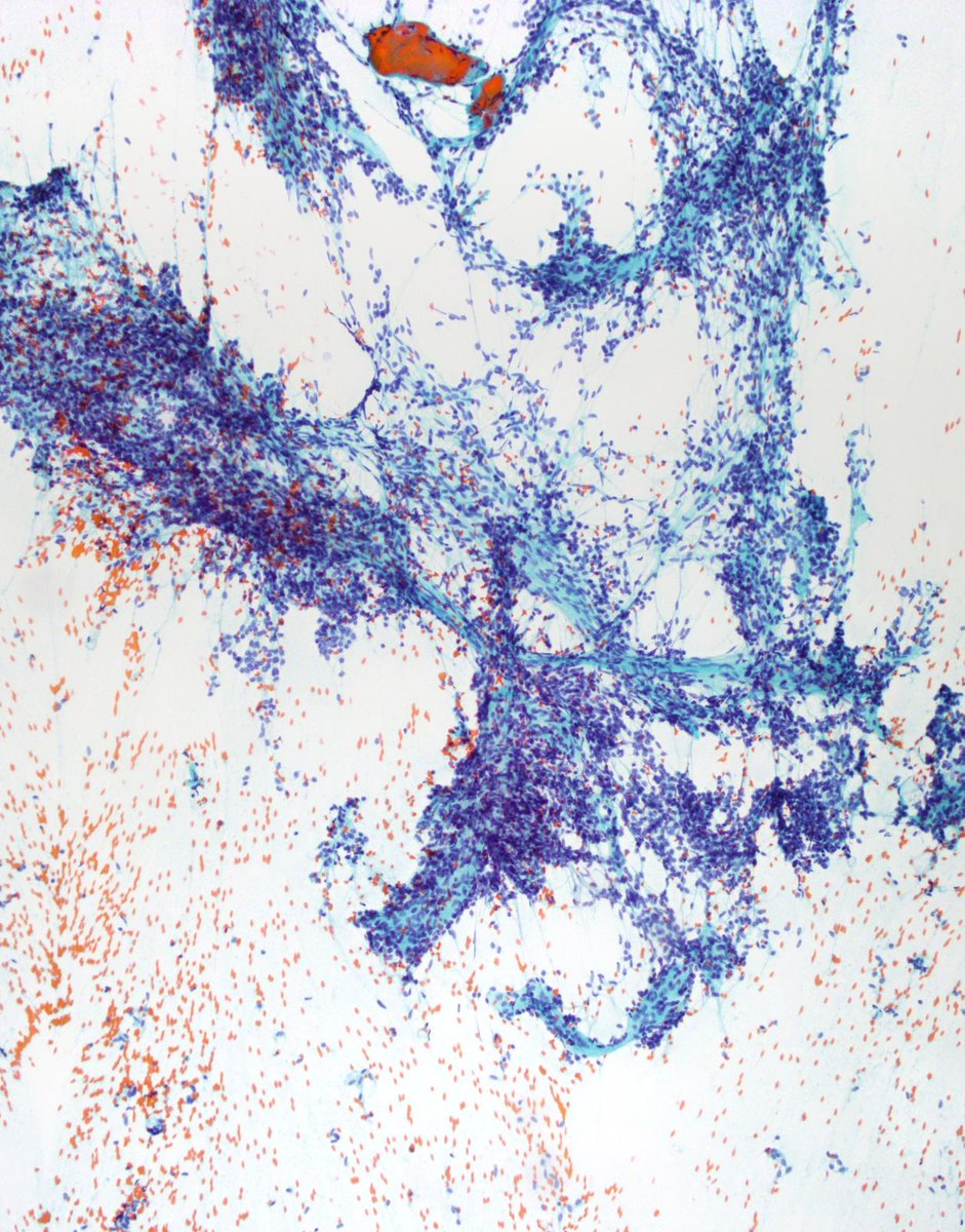 Solitary fibrous tumor: • Fibroblastic neoplasm showing a ...