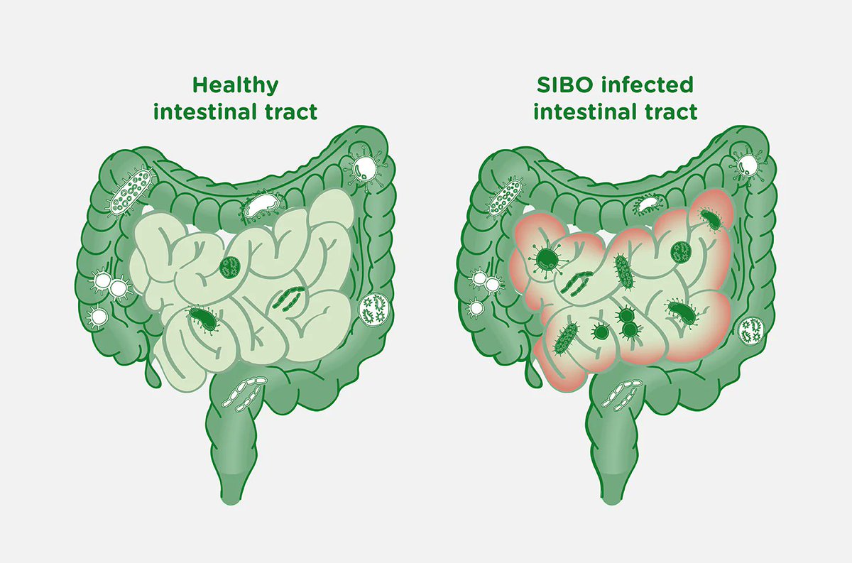 Increasing stomach acid production is HUGE for dealing with SIBO and ...