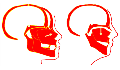 On the left, horizontal facial growth, with maxilla that is up and ...