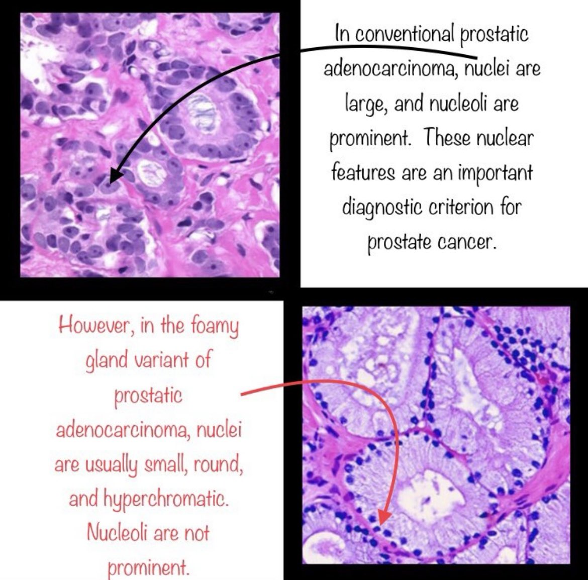 Case “A” shows a nice example of the foamy gland type of prostate ...