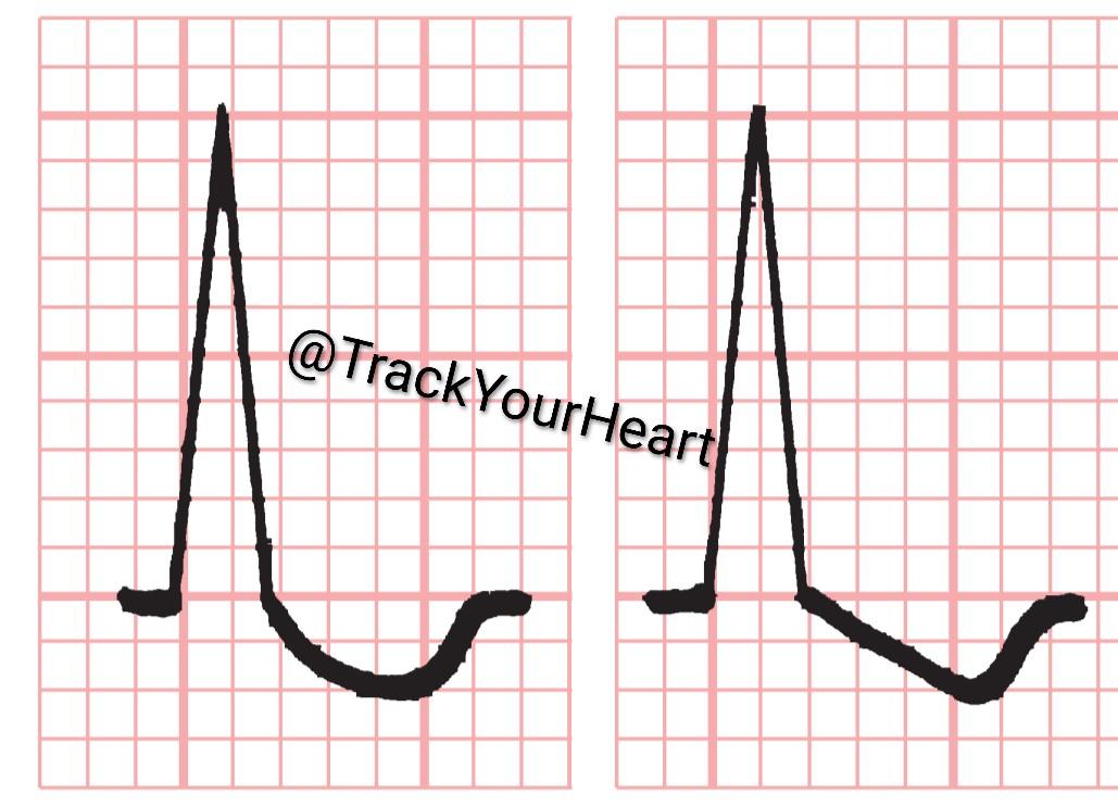 The ECG shown demonstrates a characteristic scooped ST-segment ...