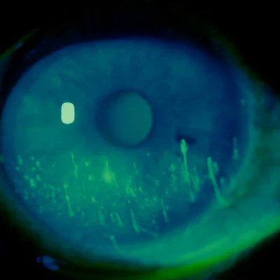 What Is Filamentary Keratitis