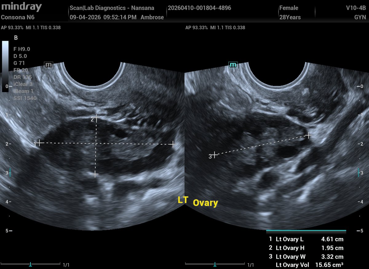 Polycystic Ovarian Syndrome (PCOS) vs Polycystic Ovaries (PCO ...