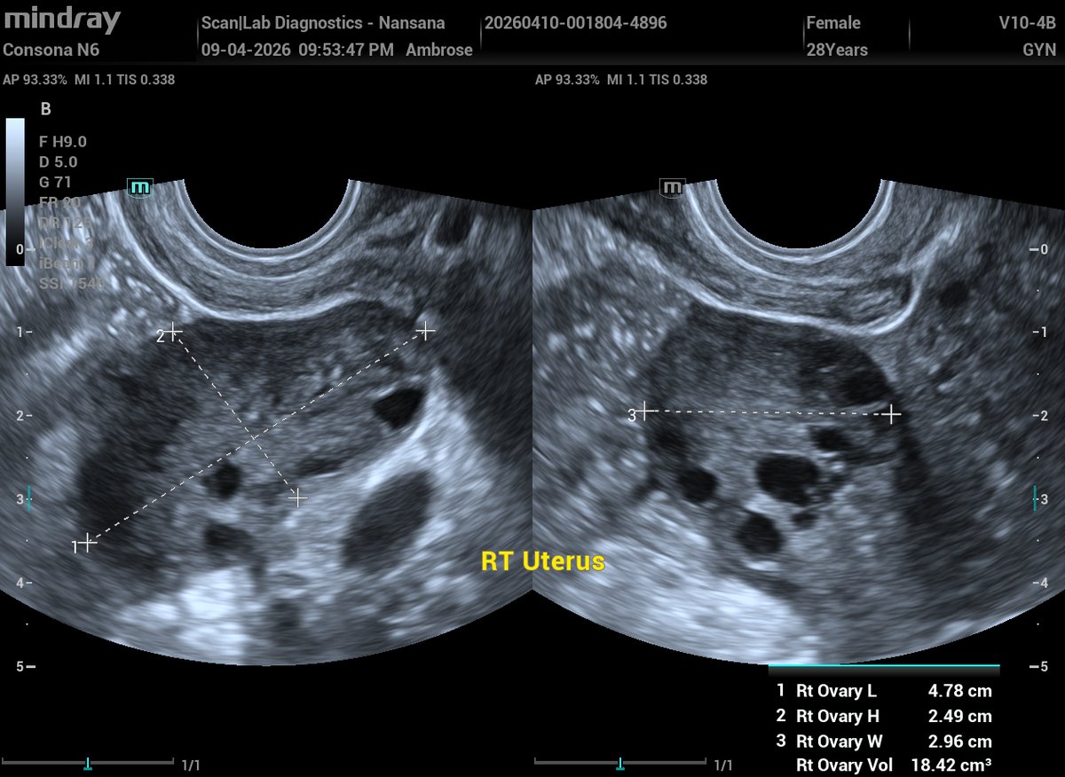 Polycystic Ovarian Syndrome (PCOS) vs Polycystic Ovaries (PCO ...