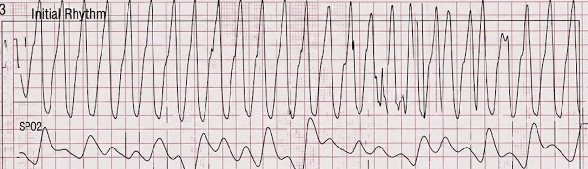 A patient collapses in the field. EMS captures this rhythm strip. What ...