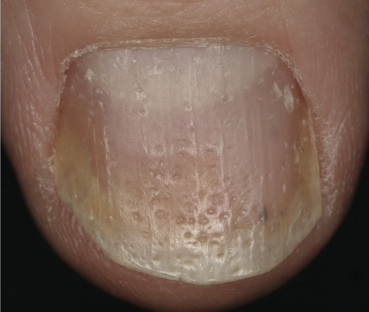 Pitting and onycholysis with a proximal rim of inflammation -point to ...